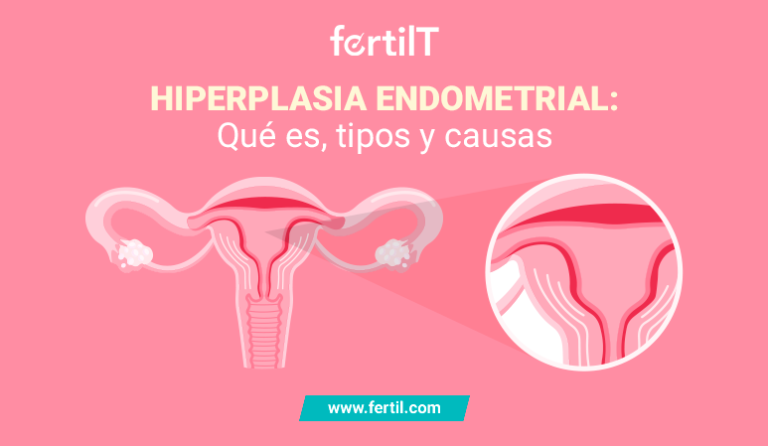 Hiperplasia endometrial: qué es, tipos y causas