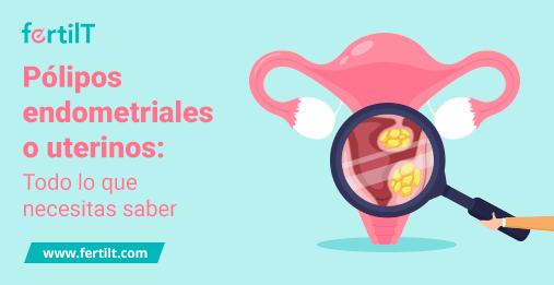 Pólipos endometriales o uterinos: Todo lo que necesitas saber